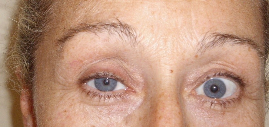 Liga Paraibana de Neurointensivismo