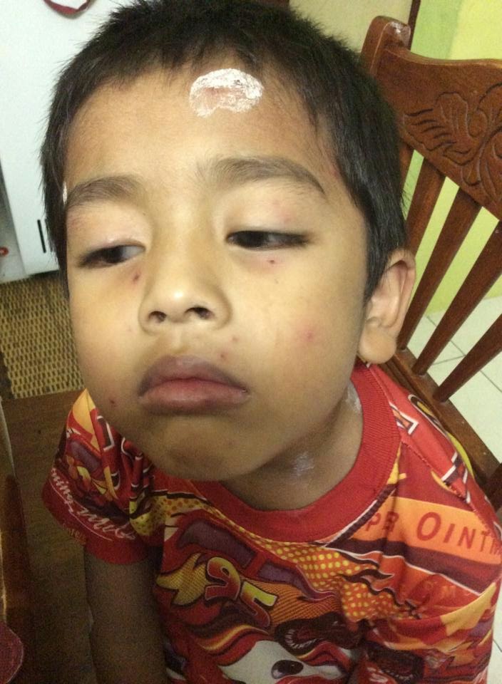 TAKUTNYA BERJANGKIT DEMAM CAMPAK/CACAR AIR | Sihat dan cergas semulajadi