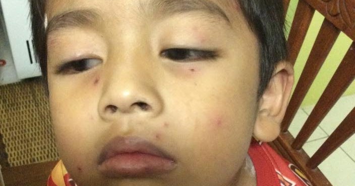 TAKUTNYA BERJANGKIT DEMAM CAMPAK/CACAR AIR | Sihat dan cergas semulajadi