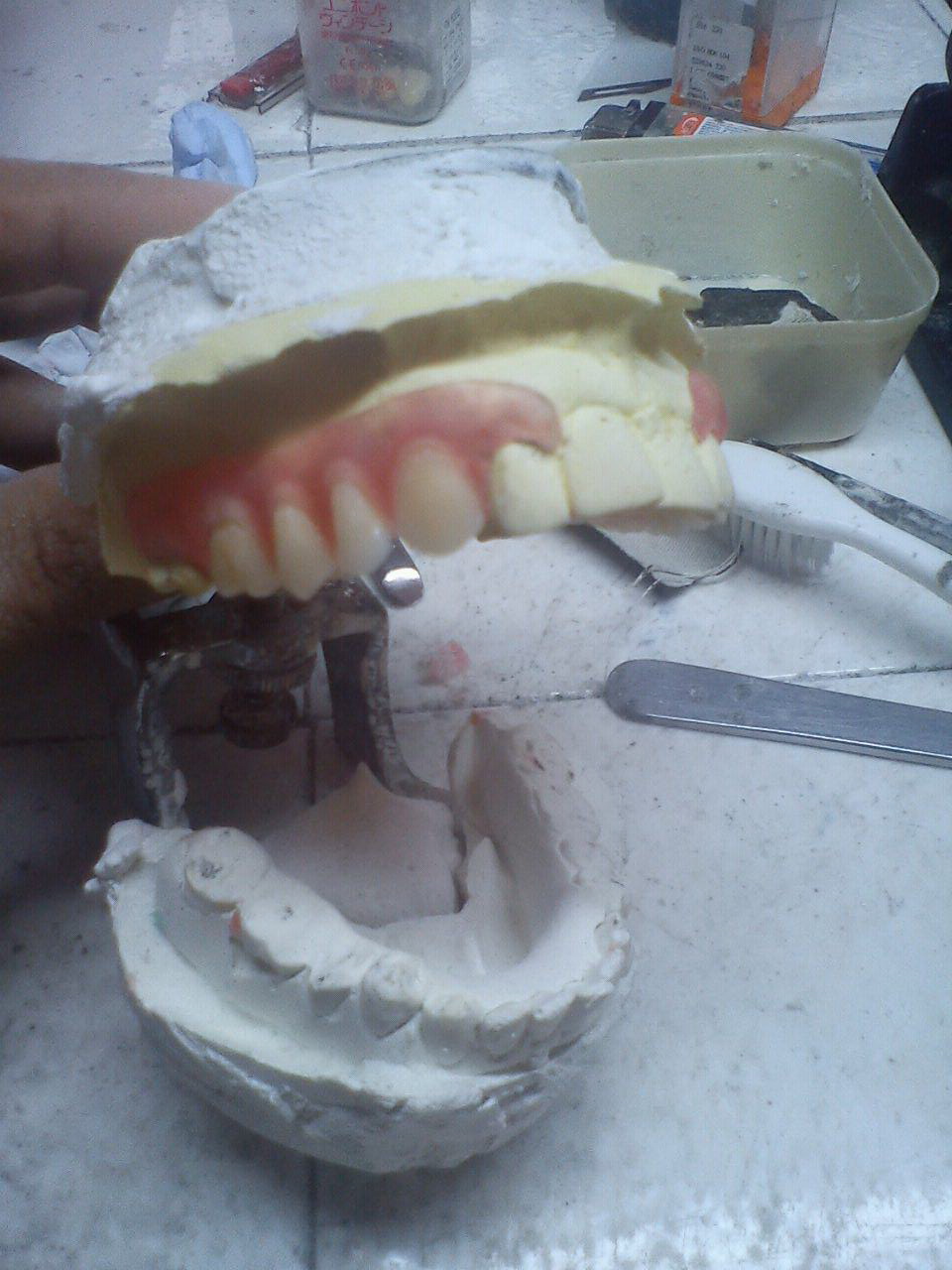 Gigi palsu/ tiruan lepasan Flexyble Valplast ~ Ahli nya Gigi Palsu di ...