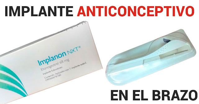 Implanon Implante anticonceptivo en el brazo | Implante hormonal ...
