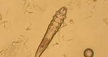 DEMODICOSIS: How to treat Demodicosis in Humans