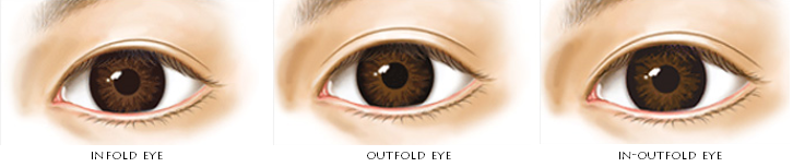 Plastic Surgery in Korea : The shape of double eyelids? What is “In/Out ...