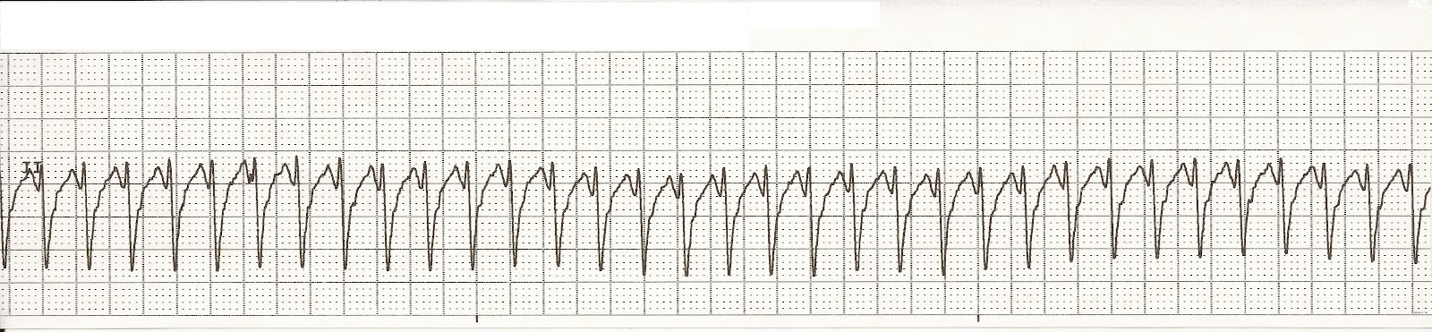 EKG Rhythm Strips 12- ventricular rhythms