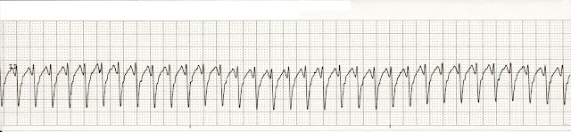 EKG Rhythm Strips 12- ventricular rhythms