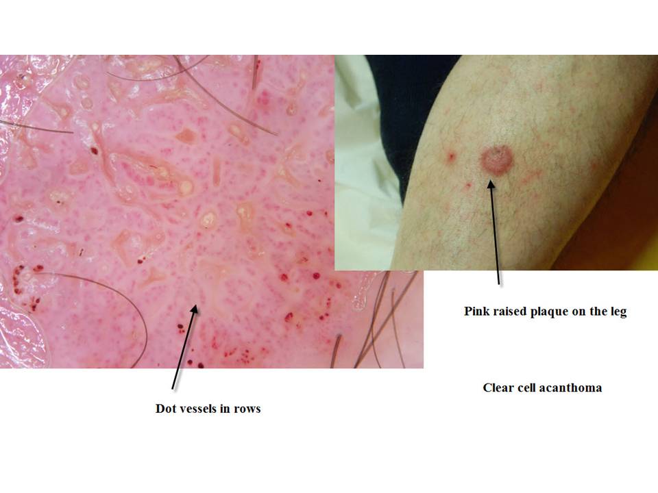 Dermpath Made Simple - Neoplastic: Seborrhoeic keratoses and Variants