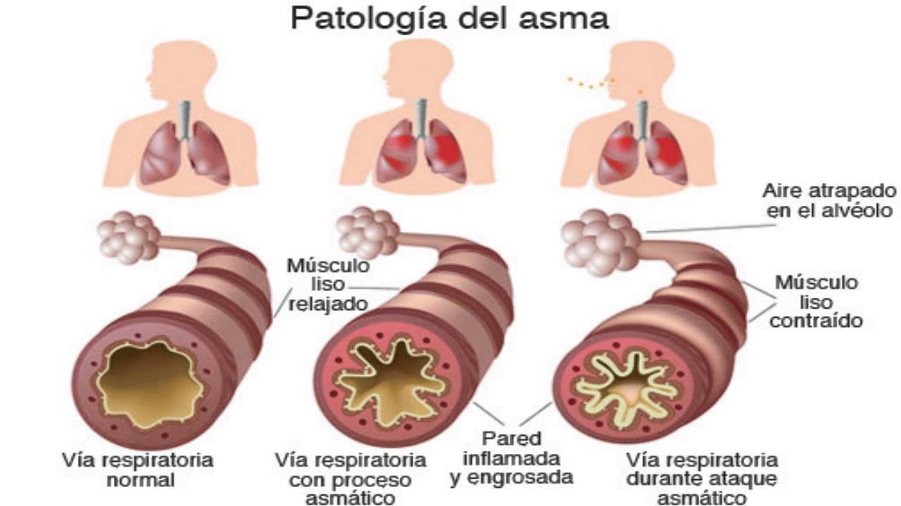 DETERMINAN LOS GENES QUE DIFERENCIAN LA EPOC DEL ASMA