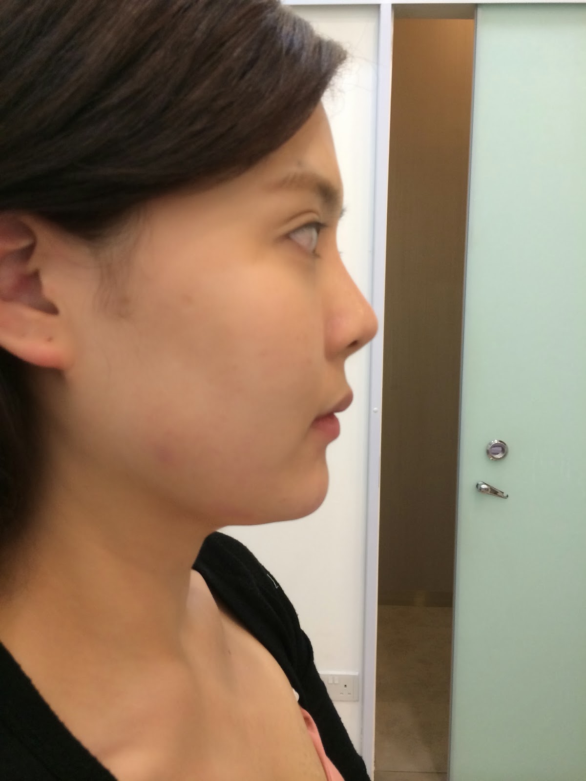 Live A Life You Will Remember : V Shaped Face - Botox and Fillers