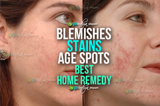 Best ever home remedy to remove blemishes, dark spots and age spots ...