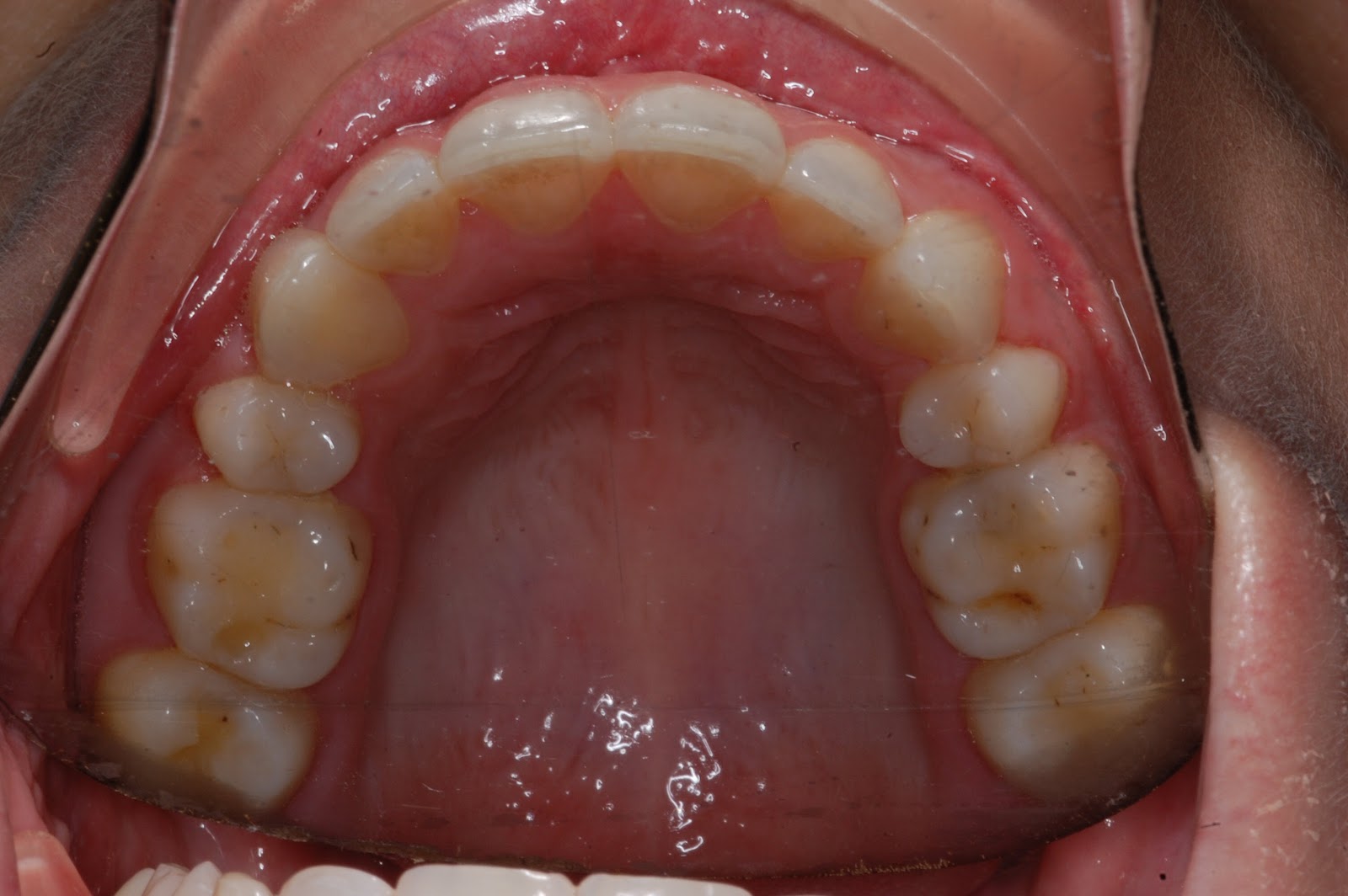 Truman Orthodontics: Orthognathic Surgery