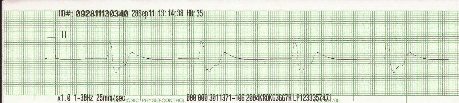 ACLS Rhythms: Ventricular rhythms
