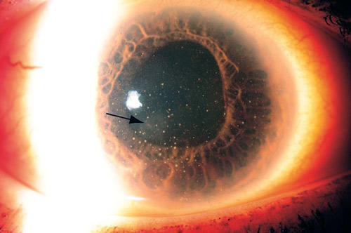 What Is Uveitis? - Teroes