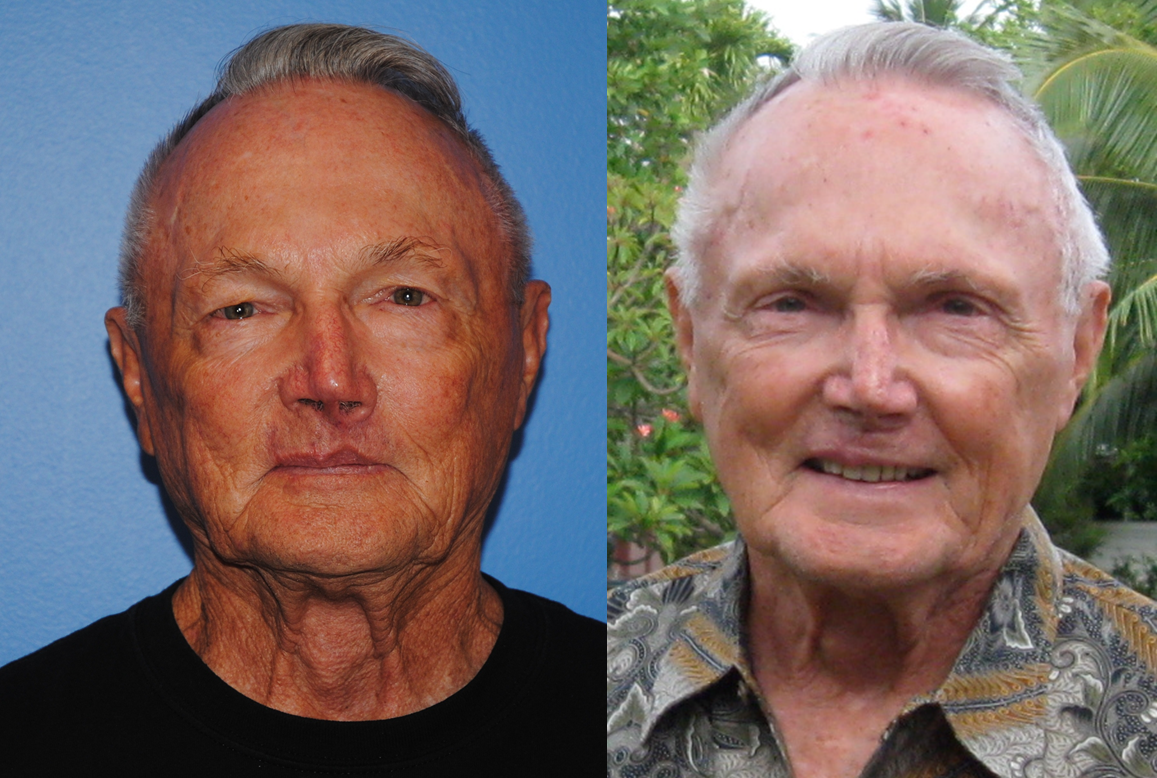 Facial Fractures, Facial Trauma, Facial Reconstruction: "Blepharoplasty ...