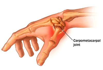 Carpometacarpal Joint Pain: Carpometacarpal Joint Pain - A Pain fame ...