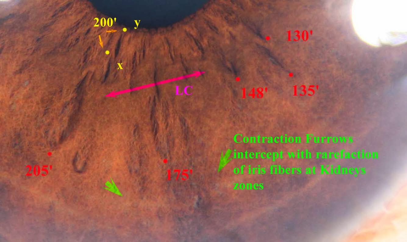 Modern & Multidimensional Iridology: Finding of Correlation Iris Signs ...