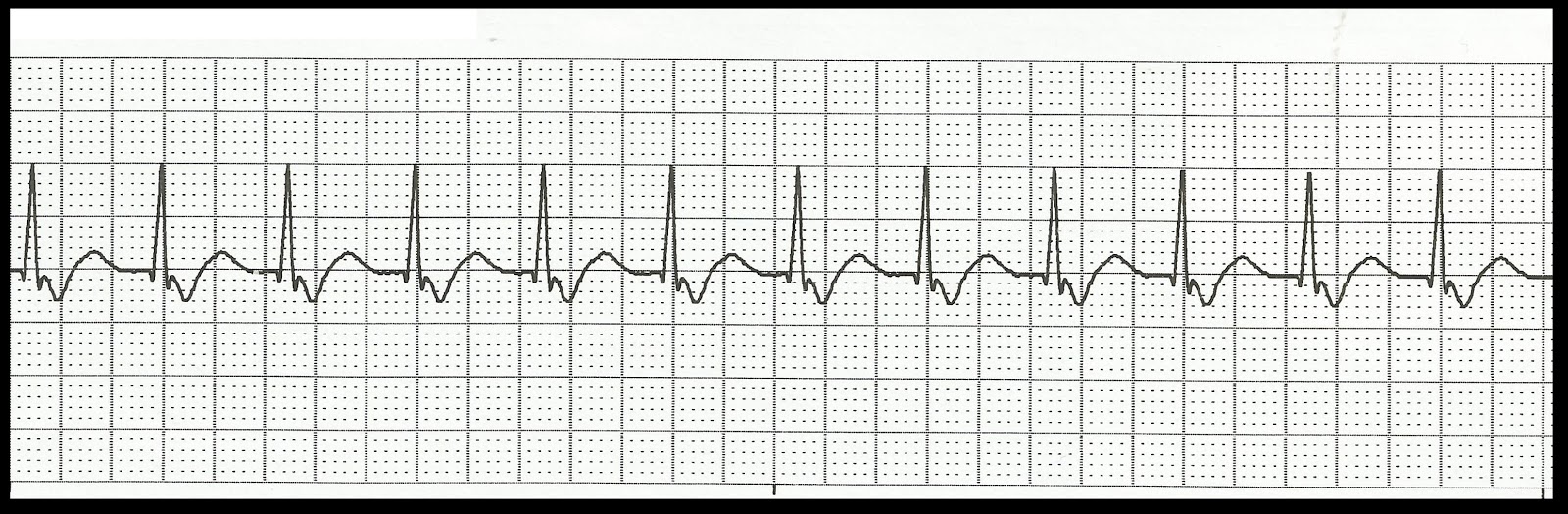 EKG Rhythm Strip Quiz 98: Junctional rhythms
