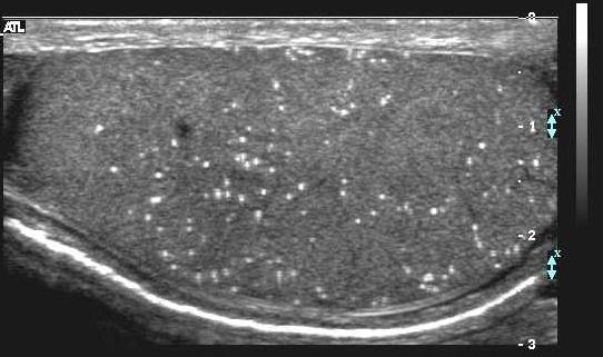 Microlitiasis Testicular