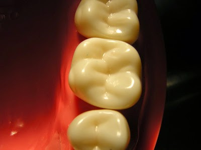 Operative Dentistry: Class I Cavity preparation & restoration on ...