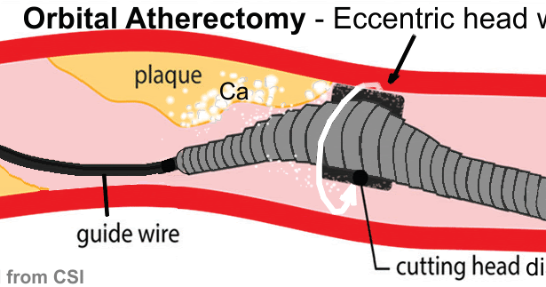 Atherectomy