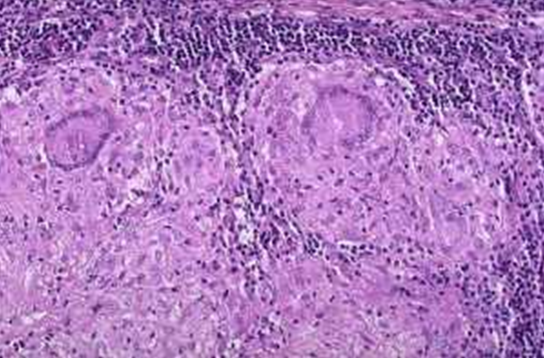 MBBS Medicine (Humanity First): Inflammation