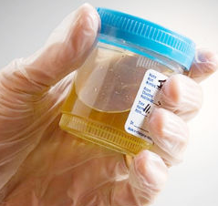 Detection of Prostate Cancer With Urine Test