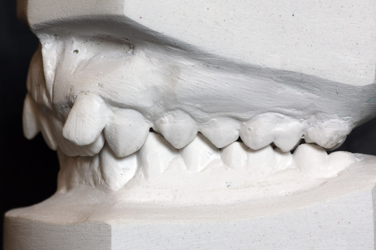 Orthodontics: UG Model Analysis Position of teeth