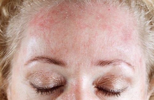 Que es la Rosacea y Como Tratarla? - La Rosacea y sus Tratamientos!