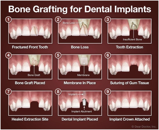 PUSAT TEKNOLOGI MATERIAL - TEKNOLOGI MATERIAL MEDIS: bonegrafting for ...