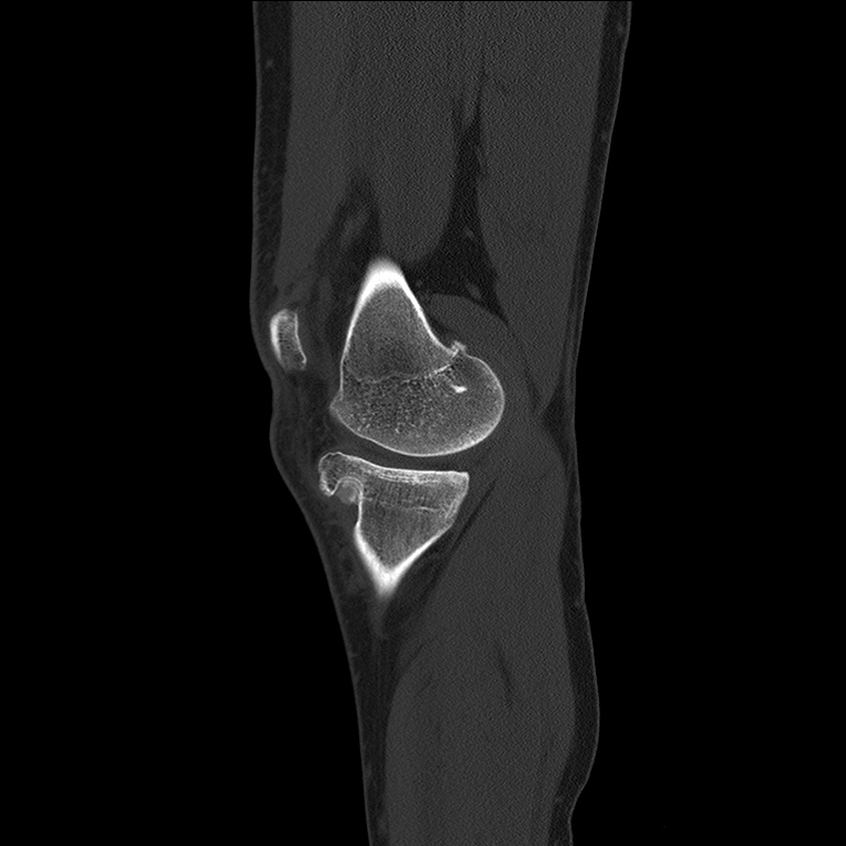 CT Knee - Radiology Imaging