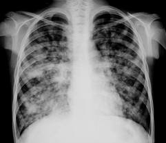NEUMONIA Y TUBERCULOSIS