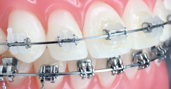 Ortodontia e Estética: self ligation system in orthodontic treatments