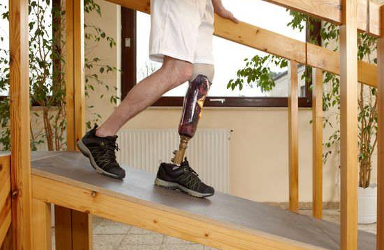 Understanding Amputation About Amputation - Doctor's Clinic