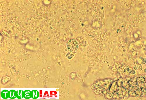 Atlas of Miscellaneous images in urine | Free Medical Atlas