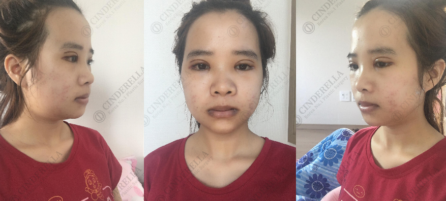 Cinderella Plastic Surgery: Cam's Real Story!