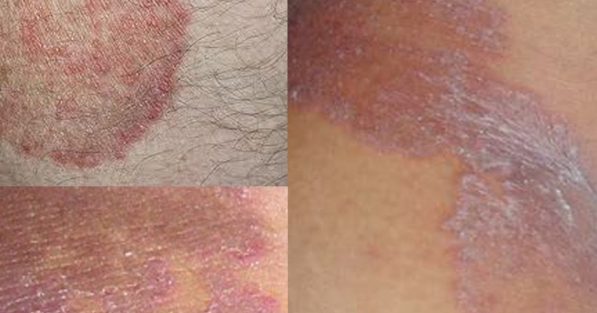 Gatal jamur di badan