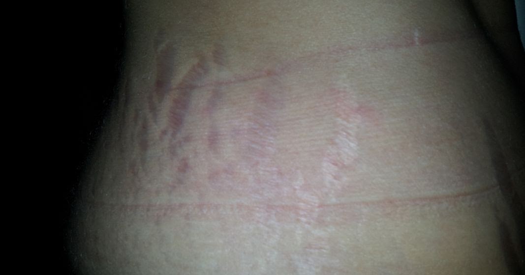 Les vergetures et Ses Causes, Solutions Naturelles | Sports et Santé