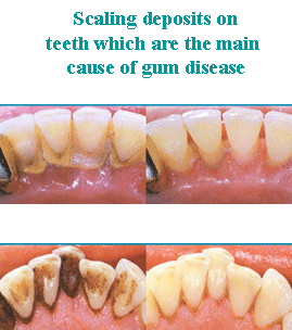 Tooth & Gums: Dental Cleaning - Dental Scaling
