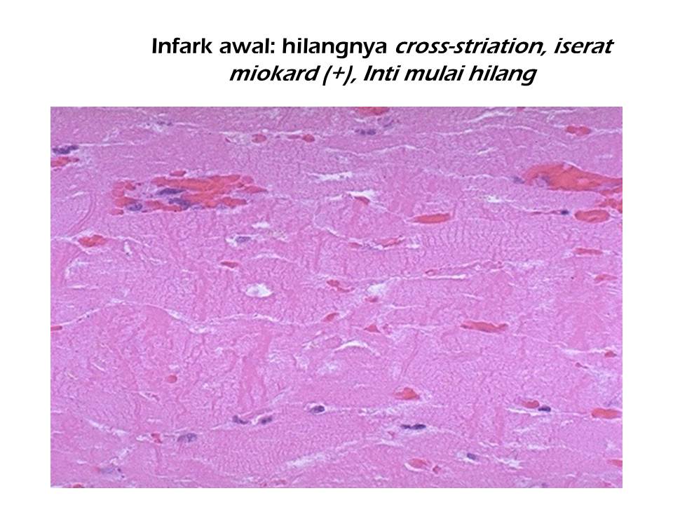 Reza Aditya Digambiro: MIOKARD INFARK