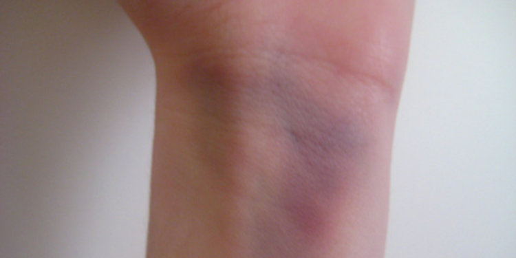 6 Reasons Why The Body Often Bruising And BleedingHealthFlatnews.cf ...