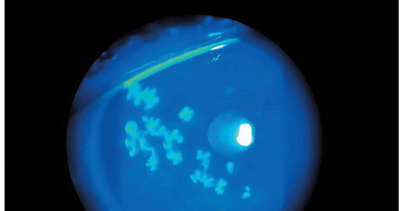 Michael Scally Md Mostly Androgens Corneal Dendrites
