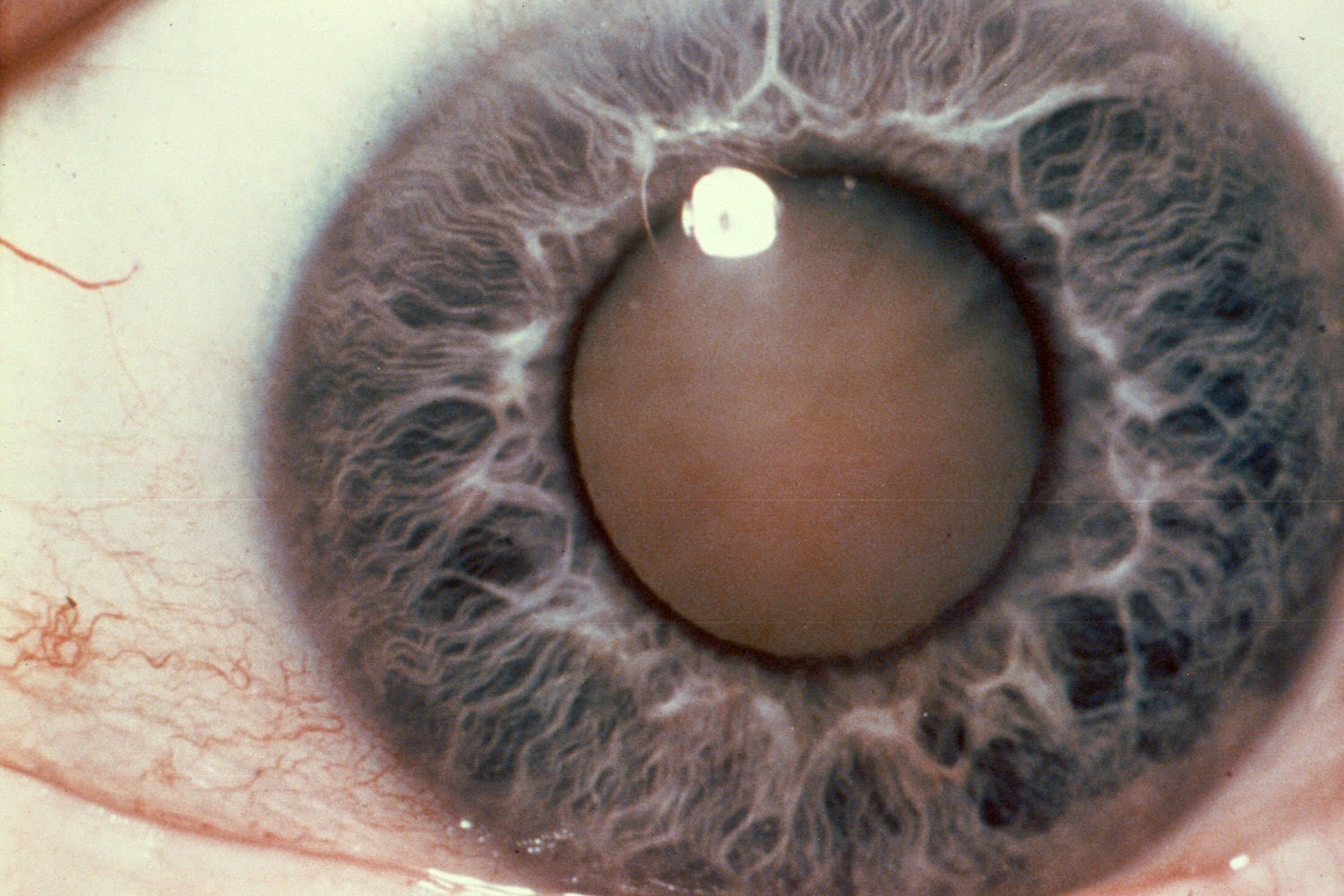 2 Penyebab Mata Katarak Akibat Penuaan