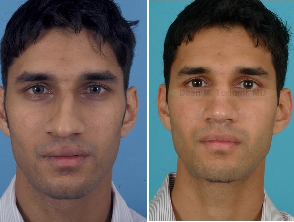 Dr. Dean Toriumi Reviews: Dean Toriumi Nasal Surgery