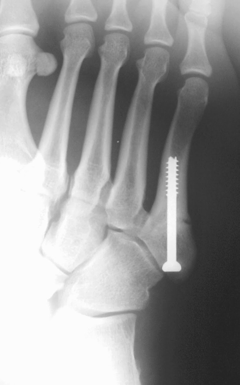 Jones Fracture Blues