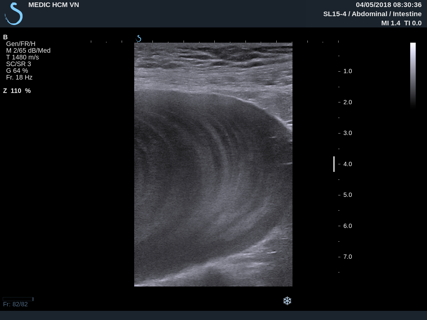 VIETNAMESE MEDIC ULTRASOUND: CASE 492 : APPENDICULAR MUCOCELE, Dr PHAN ...