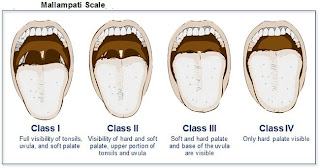 Lifecaremedi's Gallery: Mallampati scale