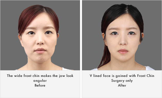 [Get to Know] Korean Face Contouring - Front Chin Surgery - 짱이뻐!