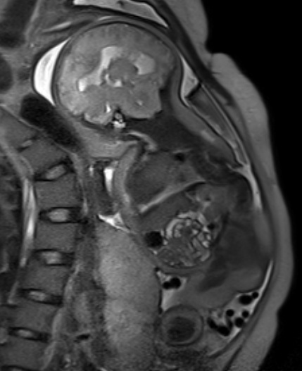 RADIOLOGY ACM With Meningomyelocele and CCA / Sacral agenesis MRI