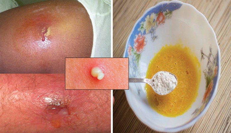 Berita TV Malaysia: MENAKJUBKAN !! JIKA ANDA MENGALAMI PENYAKIT BISUL ...