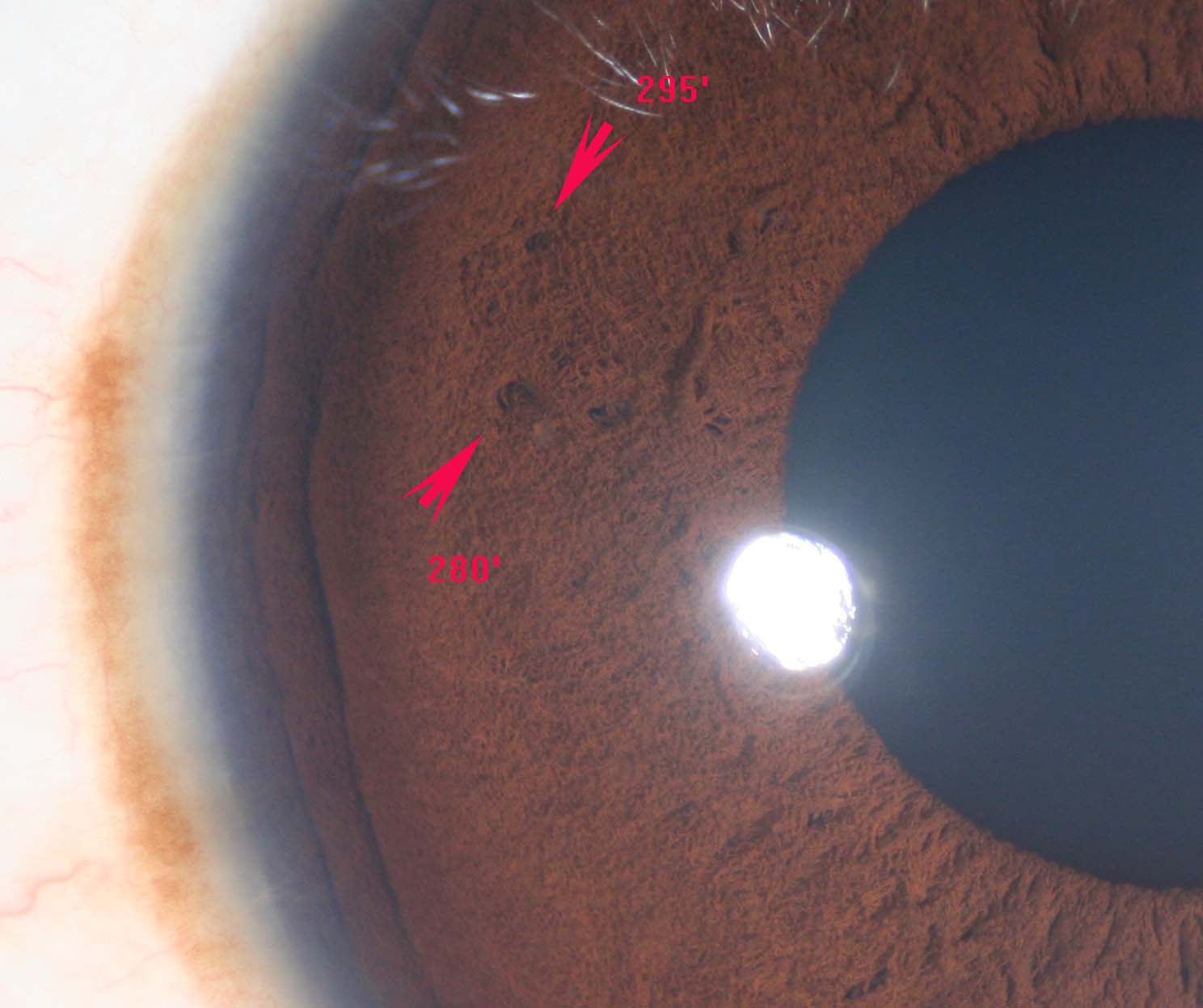 Modern & Multidimensional Iridology: Defect Markings in Brown Iris ...