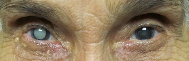 Jenis Jenis Katarak serta penjelasan lengkap